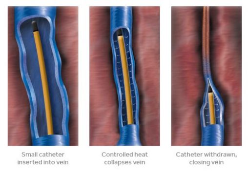ClosureFast™-lämpöablaatio | ProMedical Oy