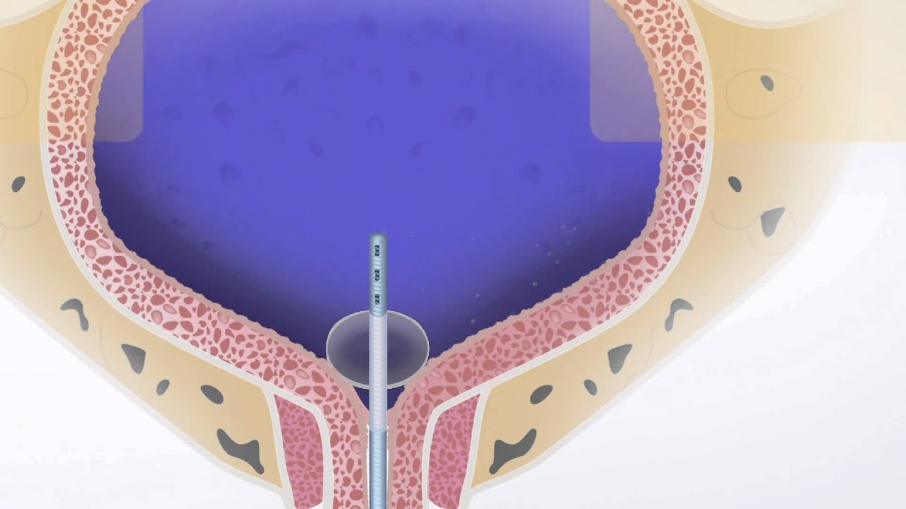 Electromotive Drug Administration - EMDA | ProMedical Oy
